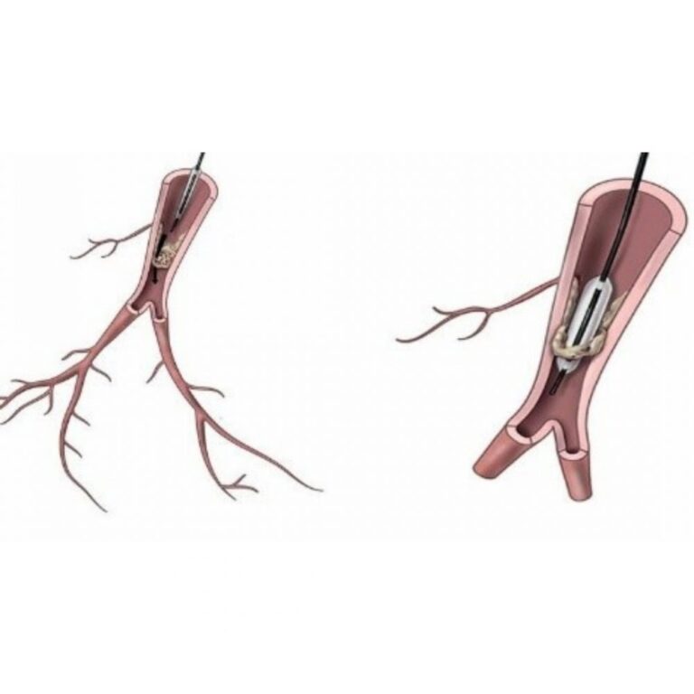 Balloon Pulmonary Angioplasty (CTEPH) – Asian Heart and Vascular Center