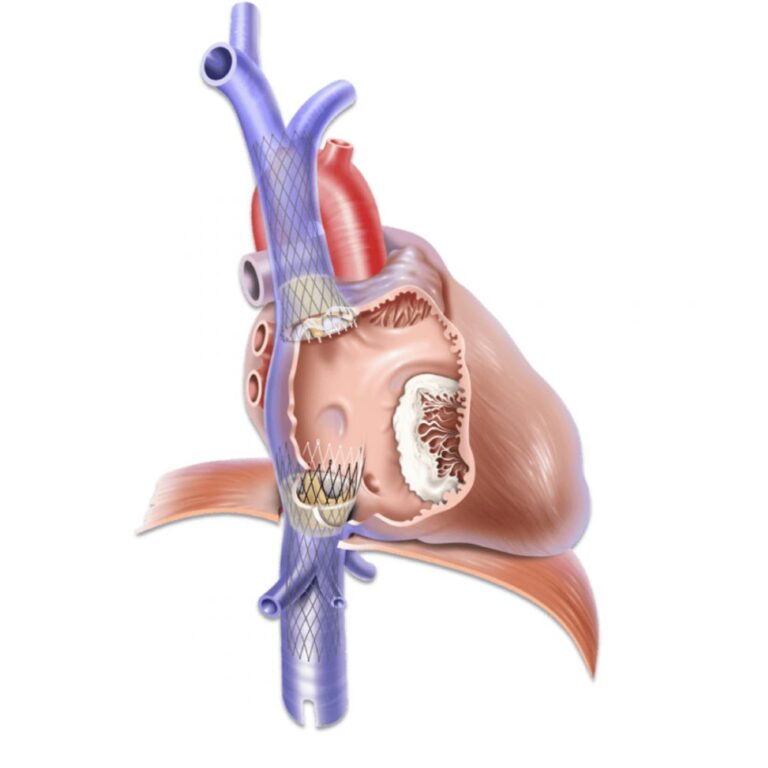 Tricuspid Regurgitation – Asian Heart and Vascular Center
