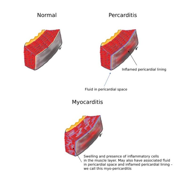 LEARNING MORE ABOUT MYOCARDITIS AND PERICARDITIS – Asian Heart and ...