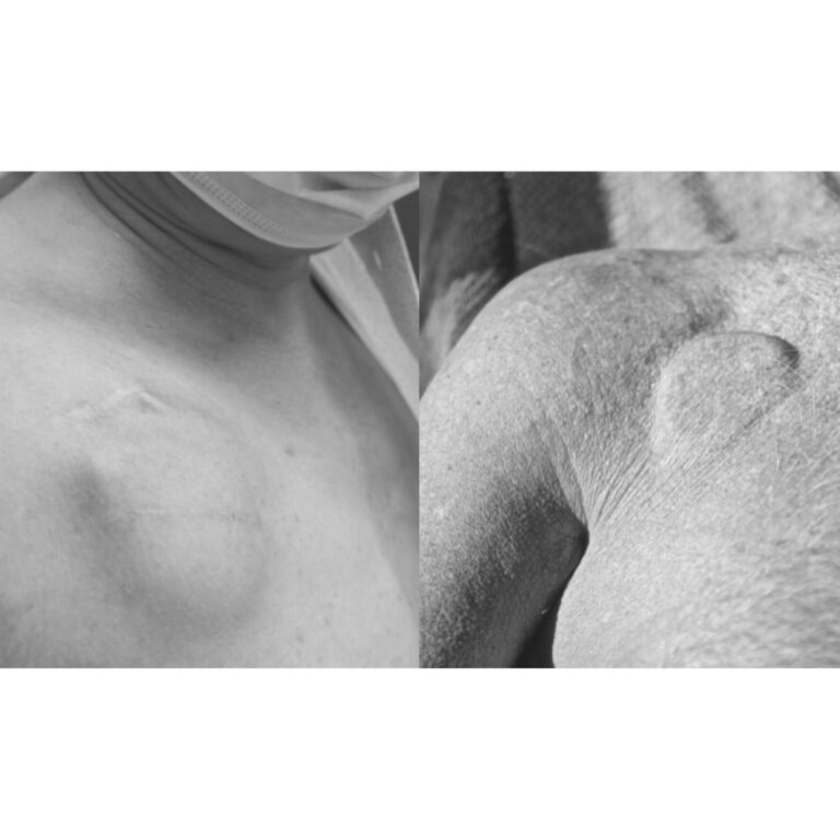 DOCTOR, I STILL WANT TO LOOK BEAUTIFUL WITH MY PACEMAKER AND ...