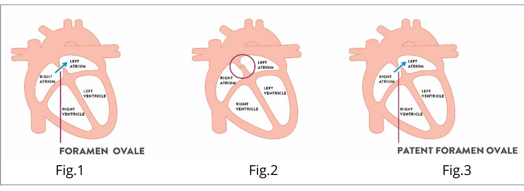 UNDERSTANDING THE RELATIONSHIP BETWEEN PFO AND STROKE – Asian Heart and ...