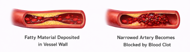 Heart Attack Vs Cardiac Arrest: Understanding The Difference - Asian ...